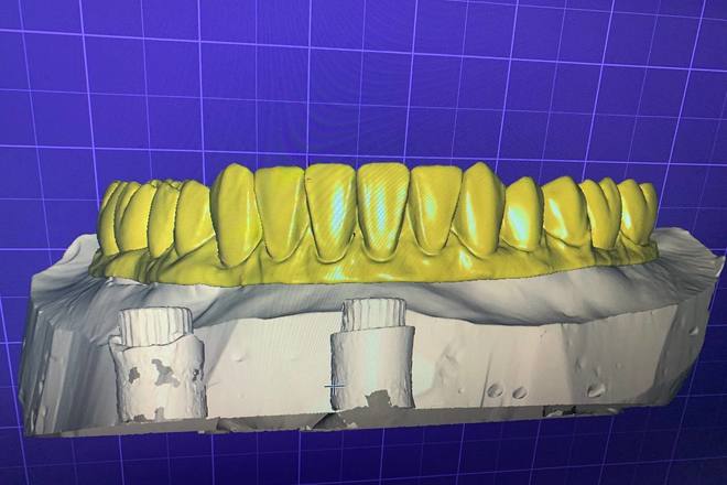 Crown & Bridge - CadCam Masters