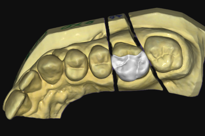 onlays and inlays - CadCam Masters