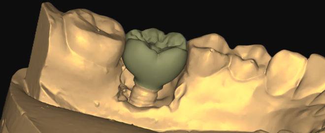 implant crown and bridge - CadCam Masters