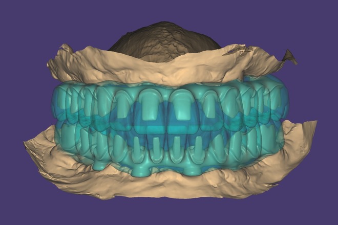 Thimble Bar - CadCam Masters