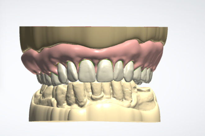 complete denture - CadCam Masters
