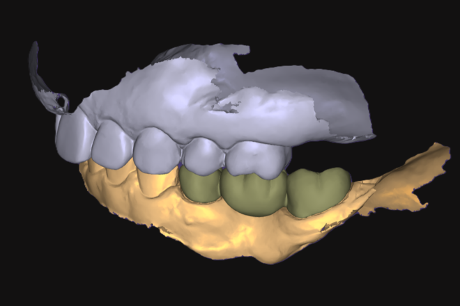 crown and bridge - CadCam Masters