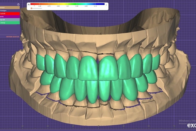 Full Arch & Single Crown & Bridge Design - CadCam Masters