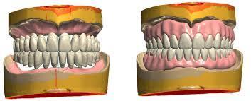 complete denture - CadCam Masters