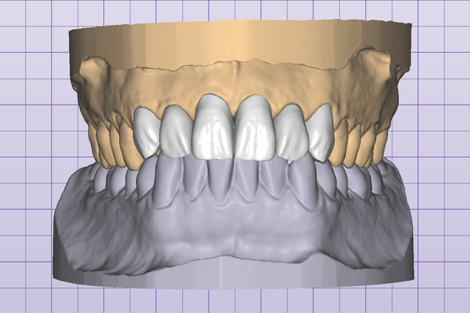 Crown/Brigde/Coping/Veneer - CadCam Masters
