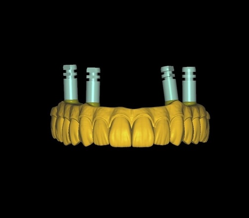Full arch over implants - CadCam Masters