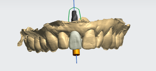 Digital Implant Planning and Surgical Guide designs - CadCam Masters