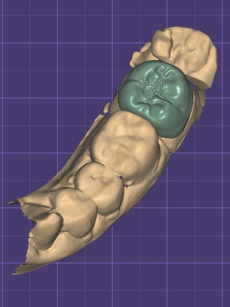 Crown,bridges - CadCam Masters