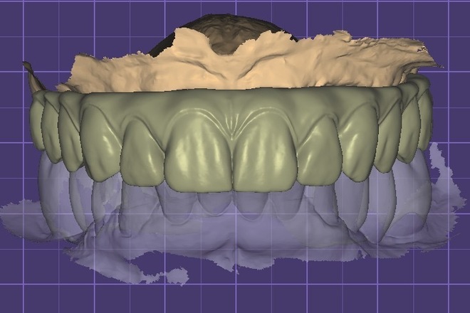 Full-arch/ immediate design - CadCam Masters