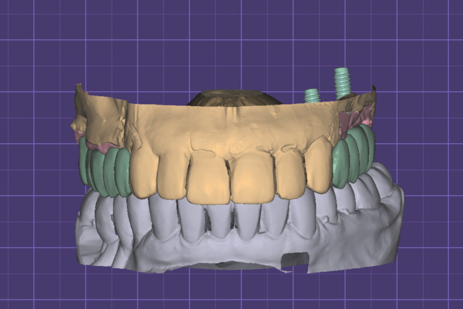 Implant Crown and bridge - CadCam Masters