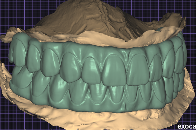 Full Arch for Implant - CadCam Masters