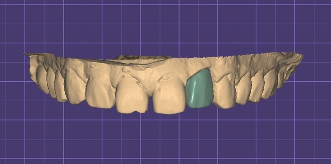 Single crowns - CadCam Masters