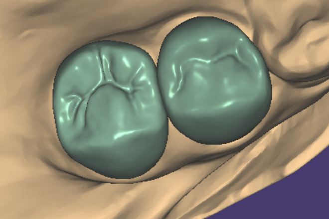 Multiple Crown & Bridge - CadCam Masters