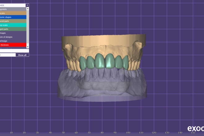 DSD & anterior and posterior crowns or bridges & Veneers - CadCam Masters
