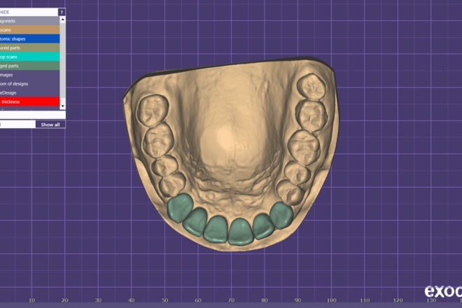 DSD & anterior and posterior crowns or bridges & Veneers - CadCam Masters