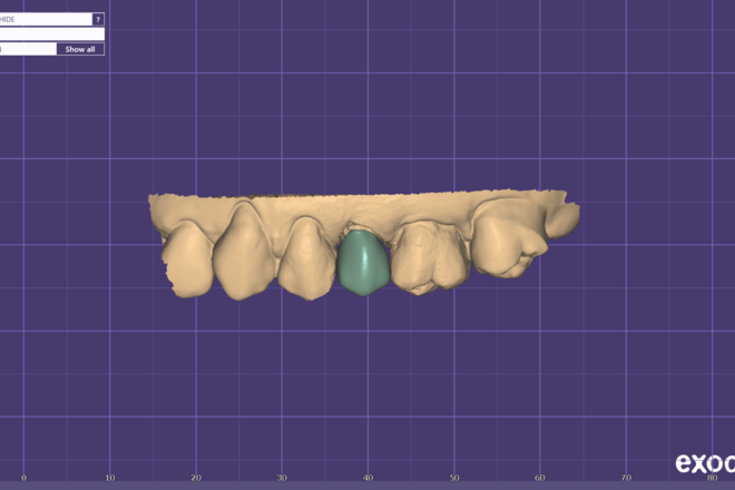 DSD & anterior and posterior crowns or bridges & Veneers - CadCam Masters