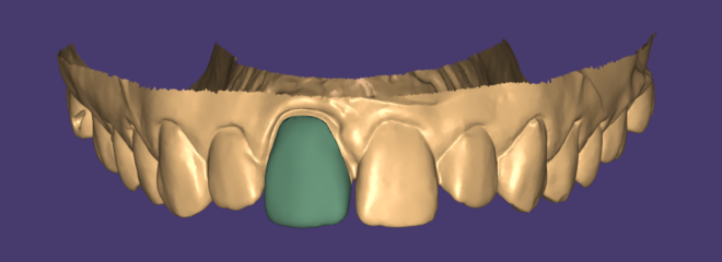 DSD & anterior and posterior crowns or bridges & Veneers - CadCam Masters