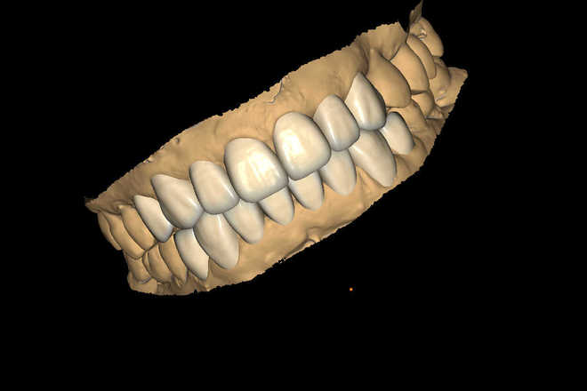 Full-contour onlays/inlays/overlays, crowns and bridges. - CadCam Masters