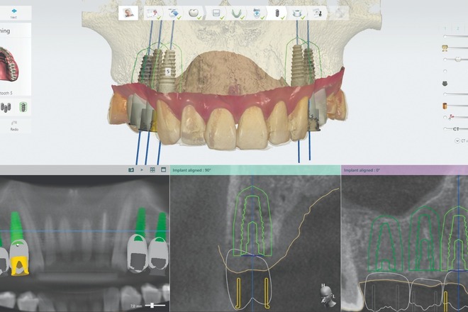 Implant Planning and Surgical Guide - CadCam Masters