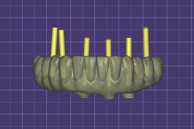 All on X Full Arch Design - CadCam Masters