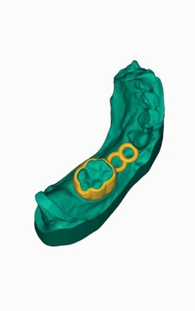 Space Maintainer Design | Pediatric Ortho - CadCam Masters