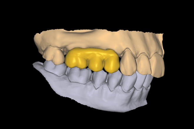 Implant-Supported Bridge - CadCam Masters