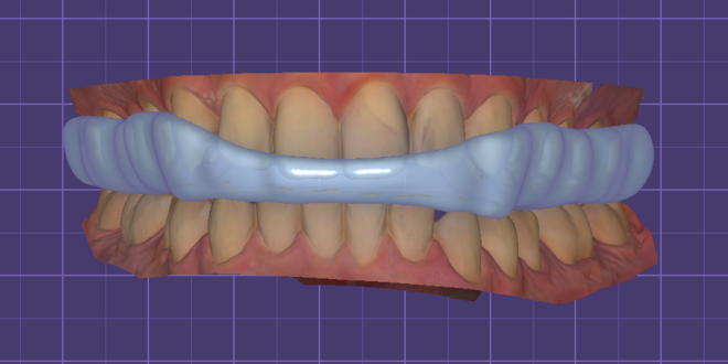 Nightguard / Splint with Properly Excursive Movements - CadCam Masters