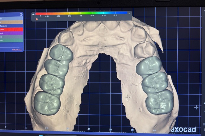 Crown & Bridge Design - CadCam Masters