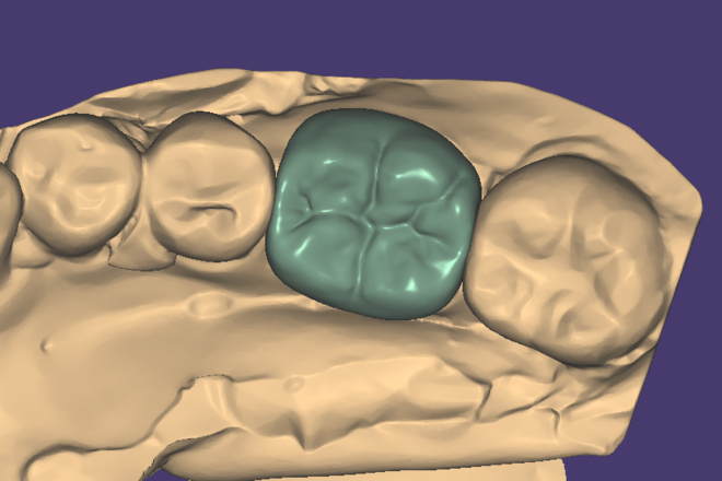 SINGLE CROWN - CadCam Masters