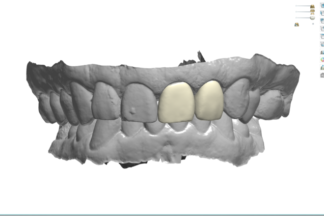 Crown & Bridge (3Shape,EXOCAD) - CadCam Masters