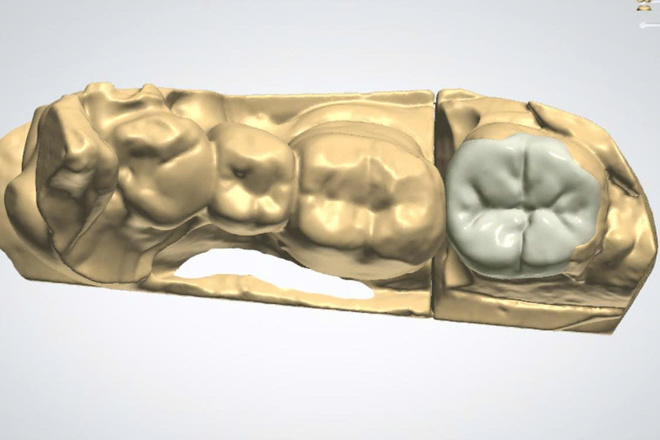 inlay & onlay - CadCam Masters