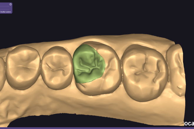 Precision Onlays and Inlays - CadCam Masters