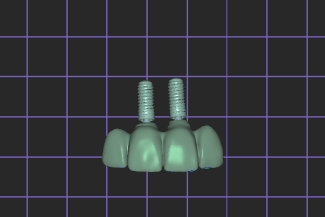 Implant Crwon&bridge cad design - CadCam Masters