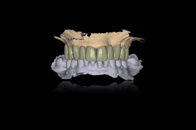 Aesthetic Crown and Bridge design - CadCam Masters