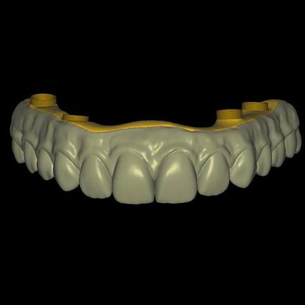Full Arch I-Bar - CadCam Masters
