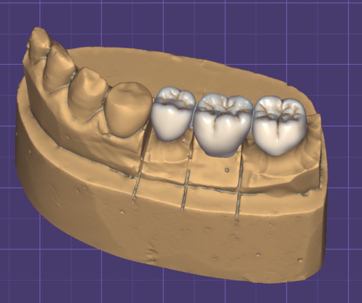 Design full anatomic crown and bridge - CadCam Masters