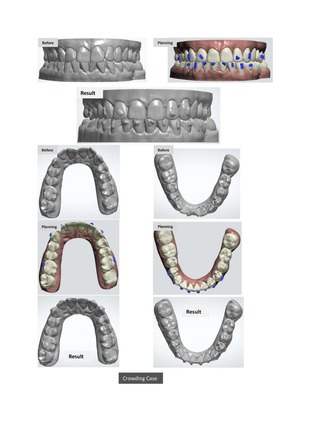 Digital Orthodontics [Clear Aligners Treatment Plan] Single Arch ...