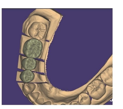 Dental cad crown & Bridge - CadCam Masters