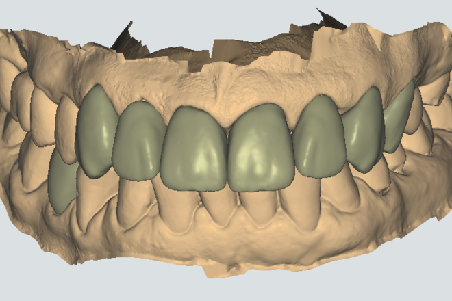 Full Arch Crowns and Bridges - CadCam Masters