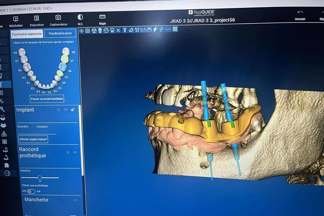 Implant planning and surgical guides design - CadCam Masters