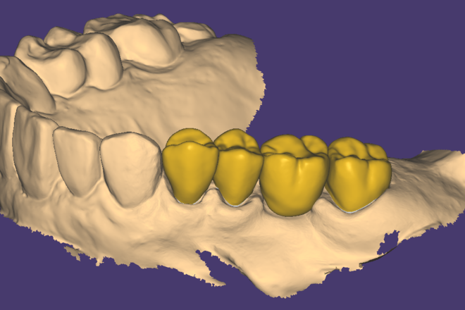 Posterior Bridge - CadCam Masters