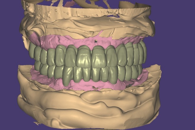 Implant crown full arch - CadCam Masters