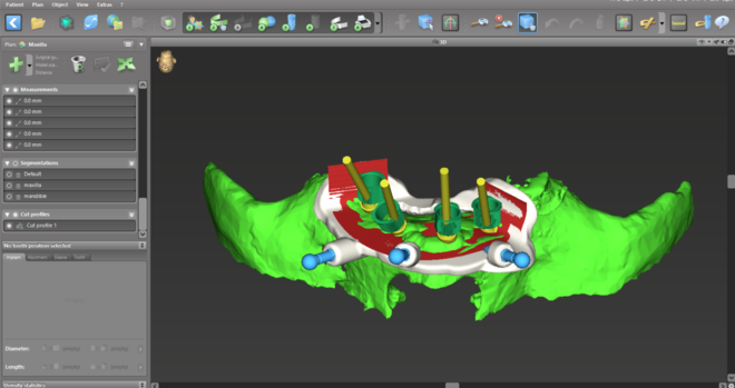 stackable guides for implant surgeries - CadCam Masters