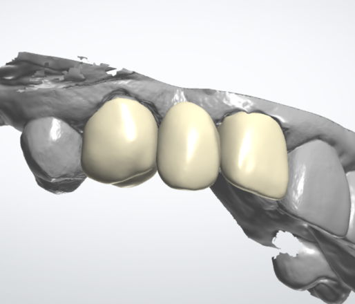 crown & bridge on 3shape - CadCam Masters