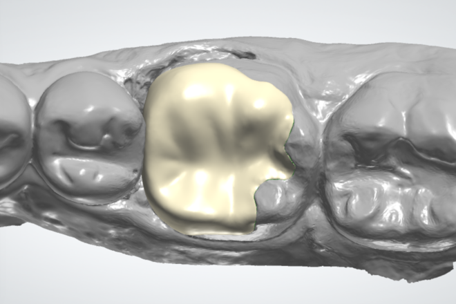 Onlay & inlay on 3shape - CadCam Masters