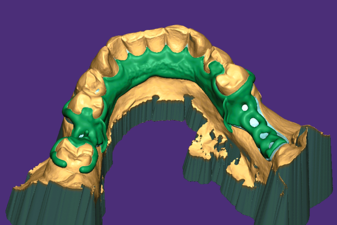 Design Metal Framework - CadCam Masters