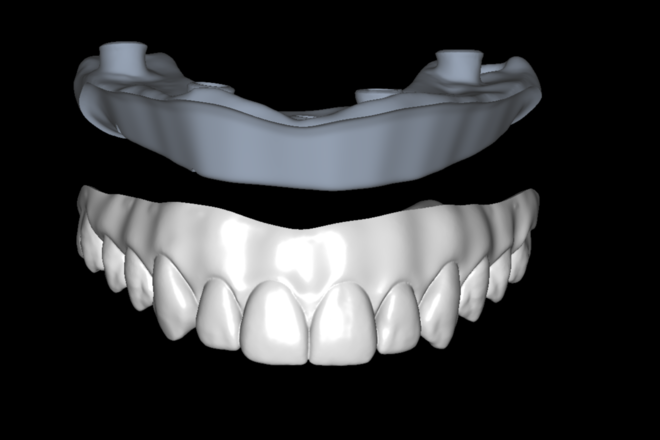 iBar for All On X (from your design) - CadCam Masters