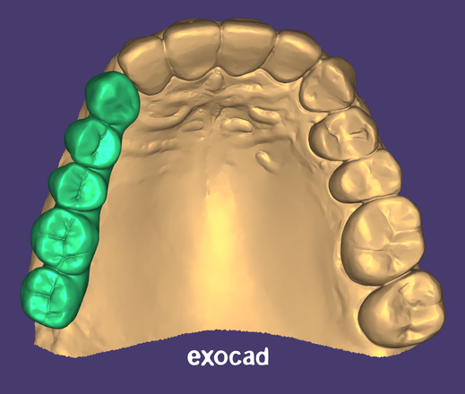 Implant/Teeth Crown & Bridge CAD Design - CadCam Masters