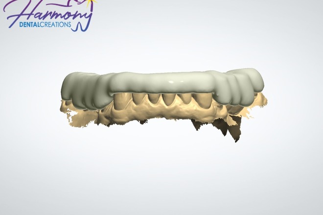 Nightguards (Bite Splint) - CadCam Masters