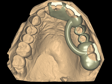 Stackable Guided Surgery - CadCam Masters